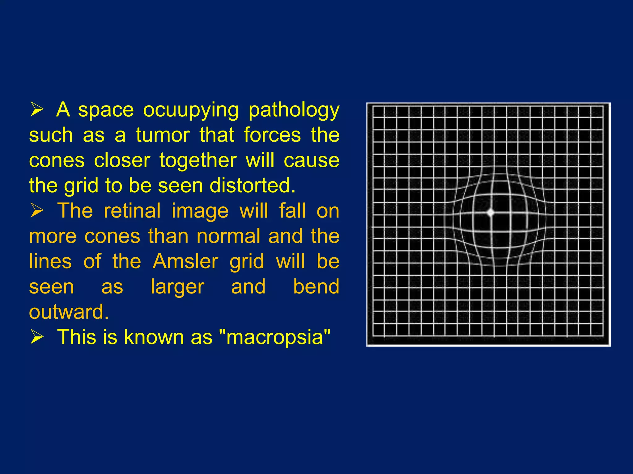 Macular function tests | PPT | Eye and Vision Conditions | Diseases and ...