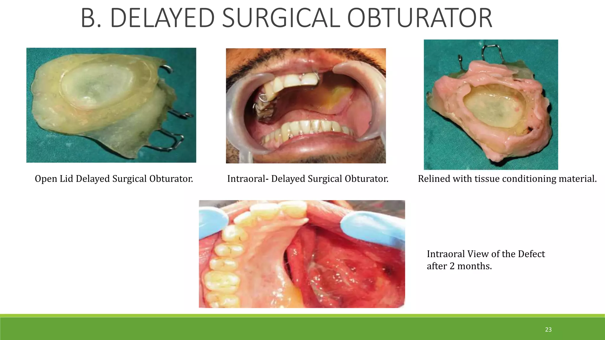 Management of acquired maxillectomy defects with obturators | PPTX