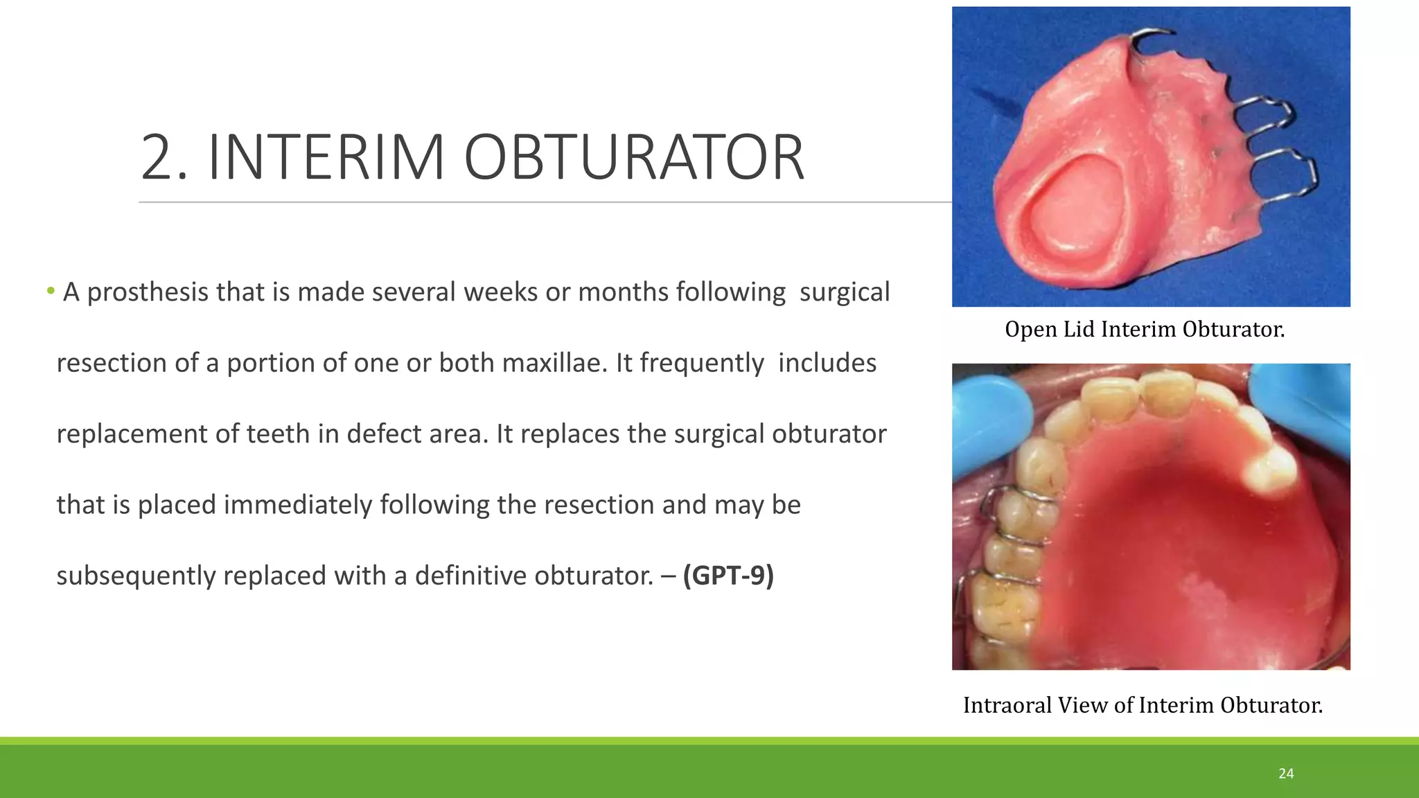 Management of acquired maxillectomy defects with obturators | PPTX