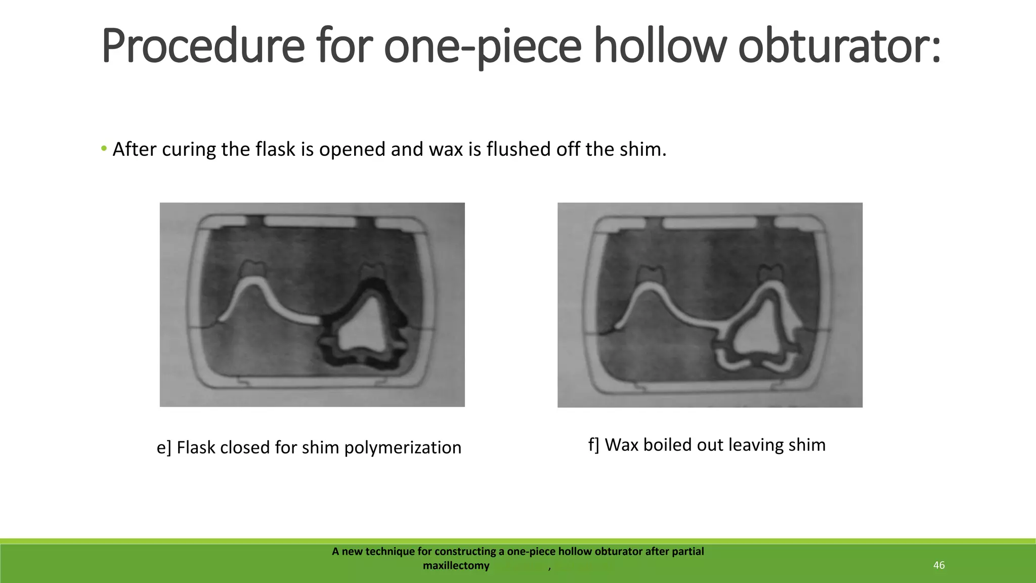 Management of acquired maxillectomy defects with obturators | PPTX