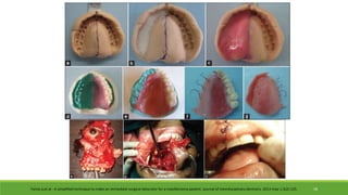 Management of acquired maxillectomy defects with obturators | PPTX