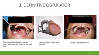 Management of acquired maxillectomy defects with obturators | PPTX