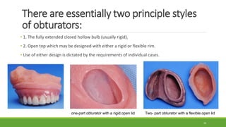 Management of acquired maxillectomy defects with obturators | PPTX