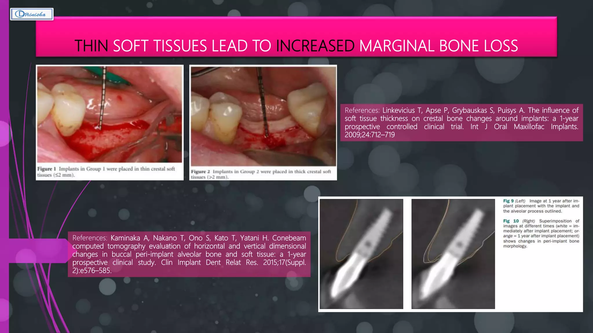 Ridge Augmentation II.pptx