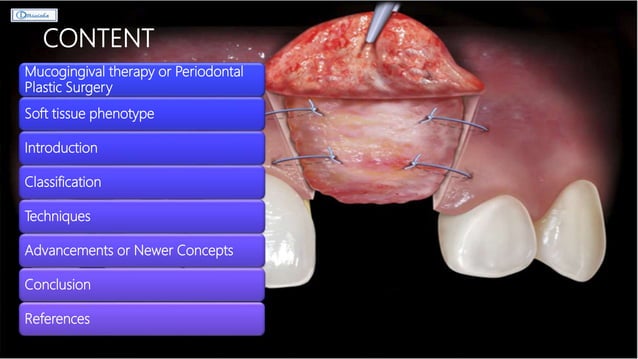 Ridge Augmentation II.pptx