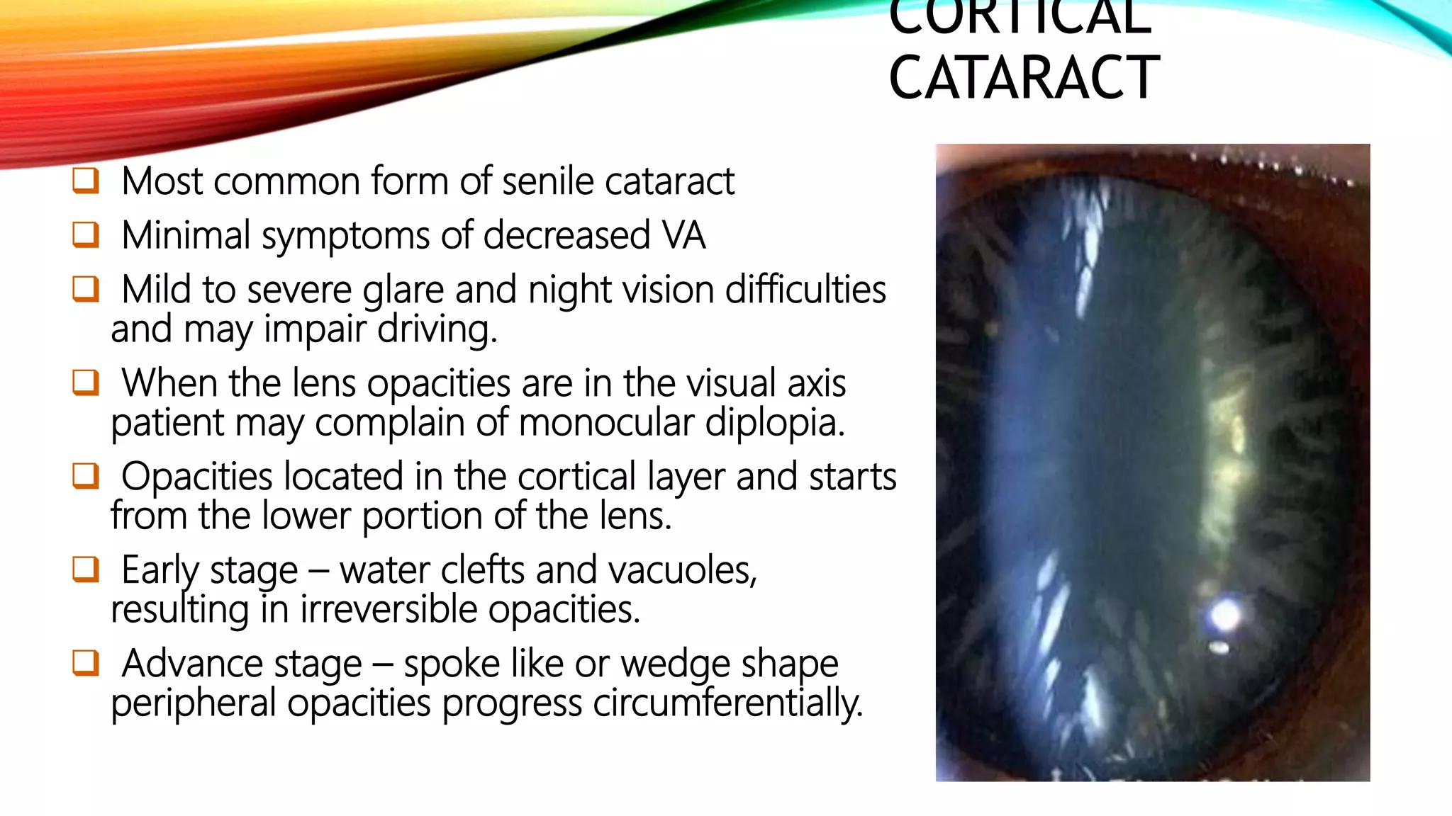 12. Cataract.pptx | Eye and Vision Conditions | Diseases and Conditions