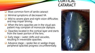 12. Cataract.pptx | Eye and Vision Conditions | Diseases and Conditions