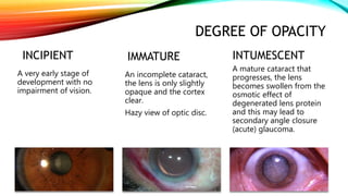 12. Cataract.pptx | Eye and Vision Conditions | Diseases and Conditions