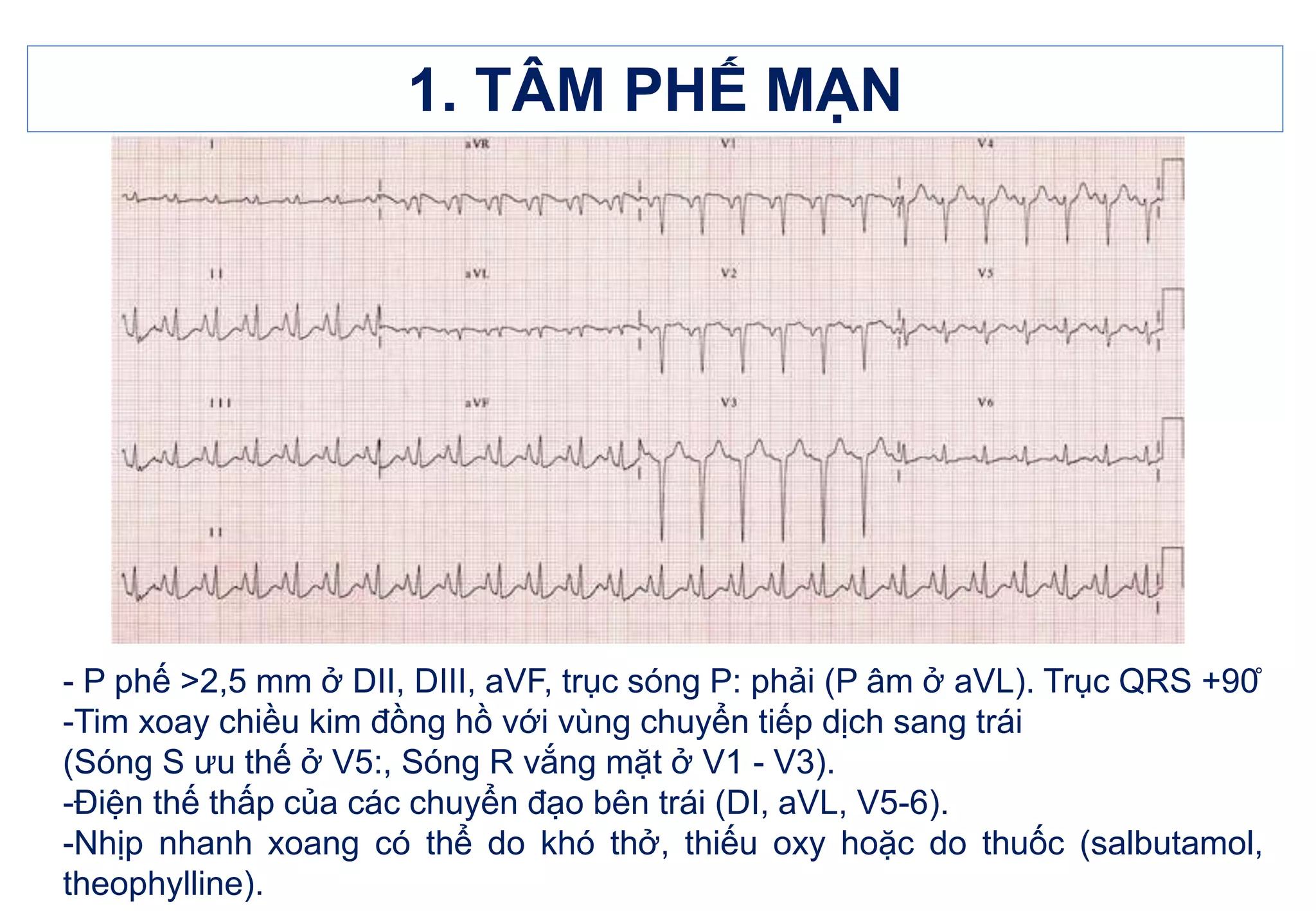 12. ECG BỆNH TÂM PHẾ.ppt