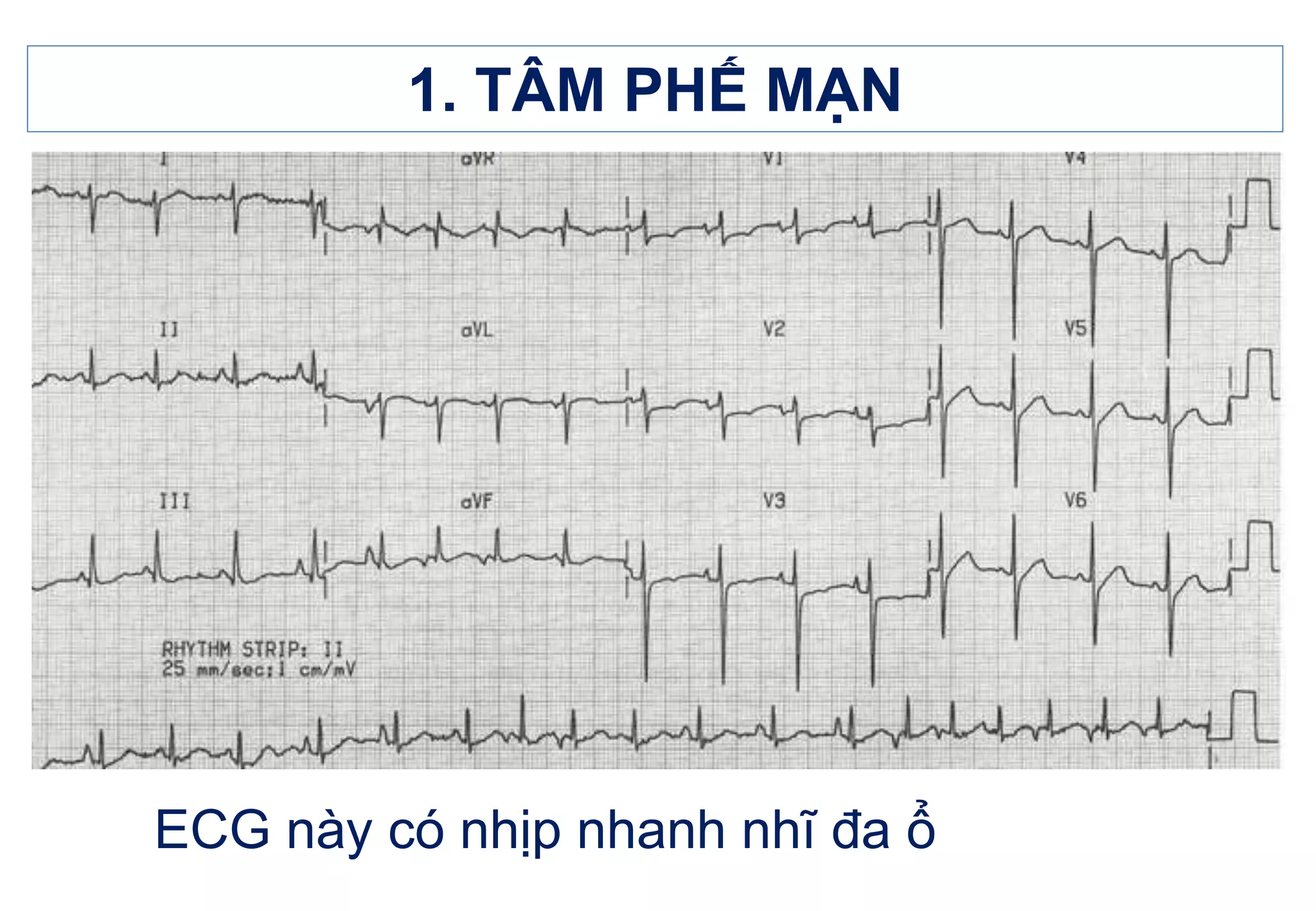 12. ECG BỆNH TÂM PHẾ.ppt