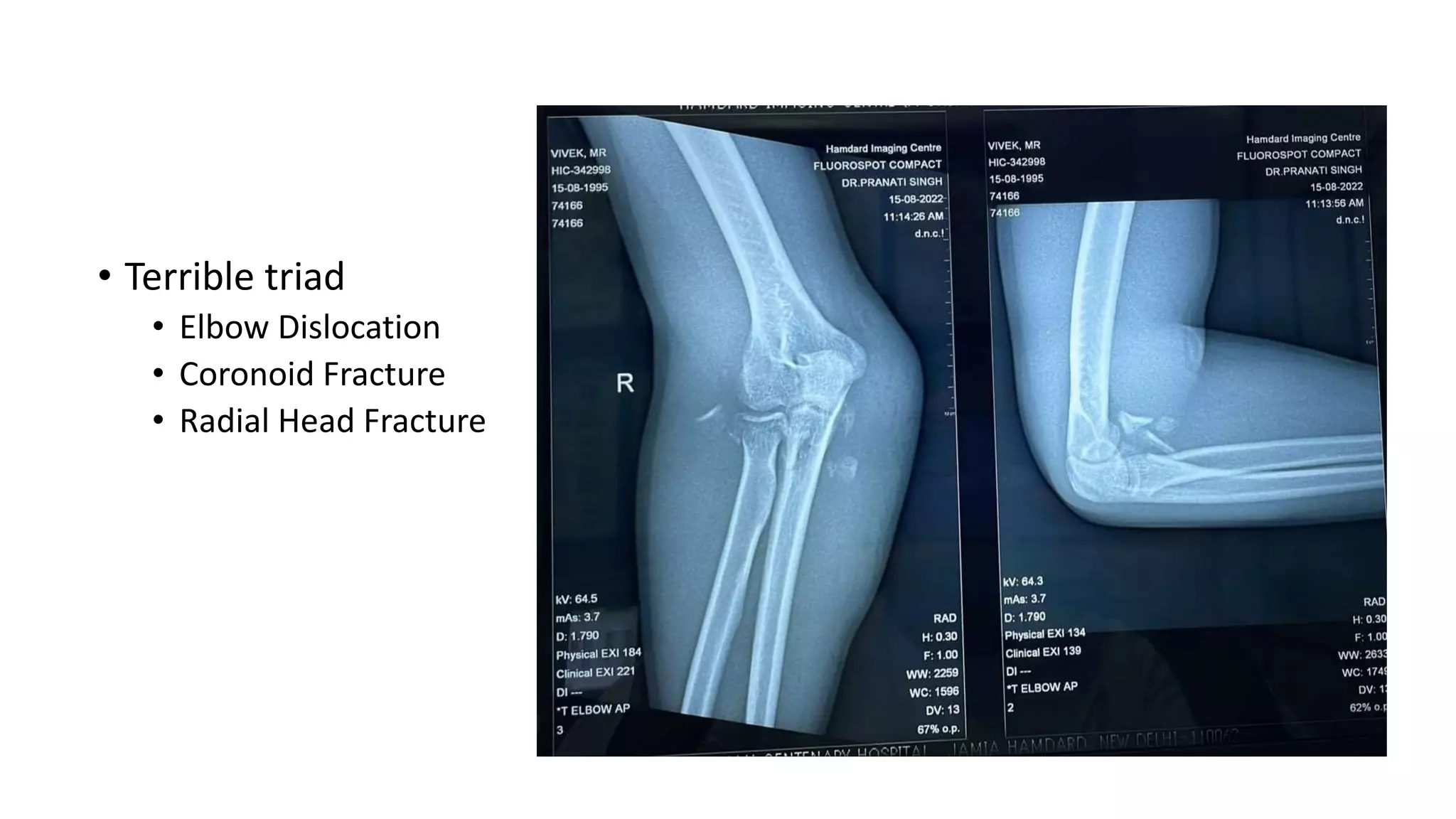 Elbow dislocations, Radial head fractures, olecranon fractures | PPT