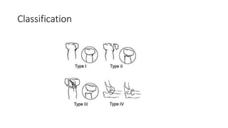 Elbow dislocations, Radial head fractures, olecranon fractures | PPT