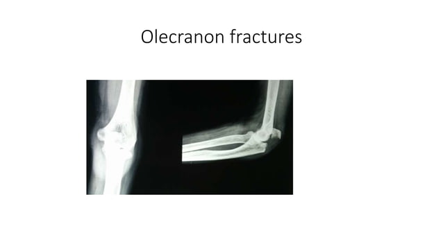 Elbow dislocations, Radial head fractures, olecranon fractures | PPT