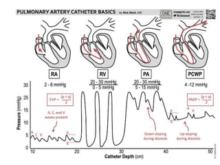 12. Right Heart Catheterization - Pros, Cons & Calculations | PPT