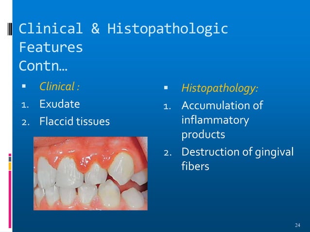 12.Chronic Periodontitis.pptx