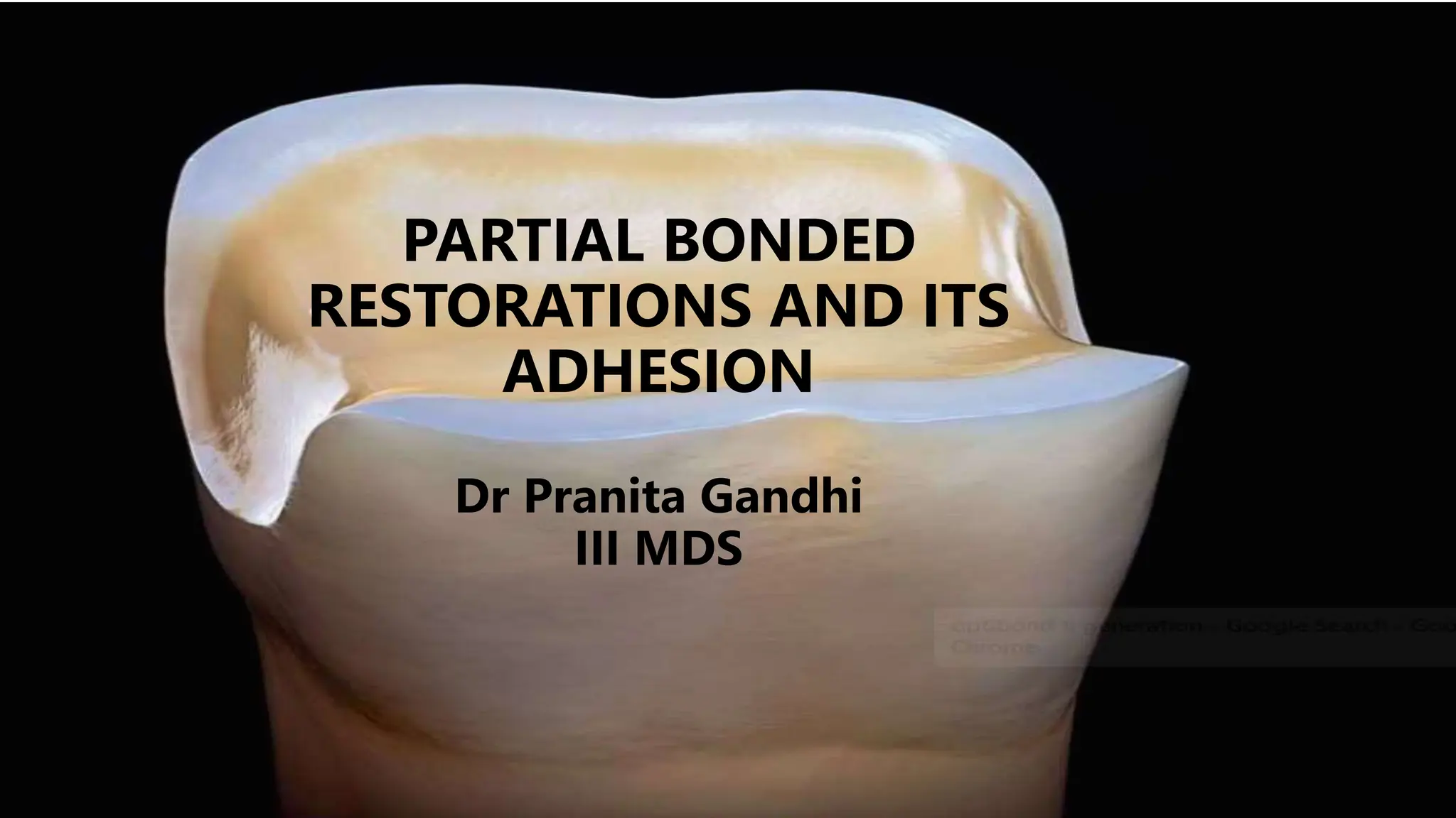 PARTIAL BONDED RESTORATIONS AND IT’S ADHESION.pptx