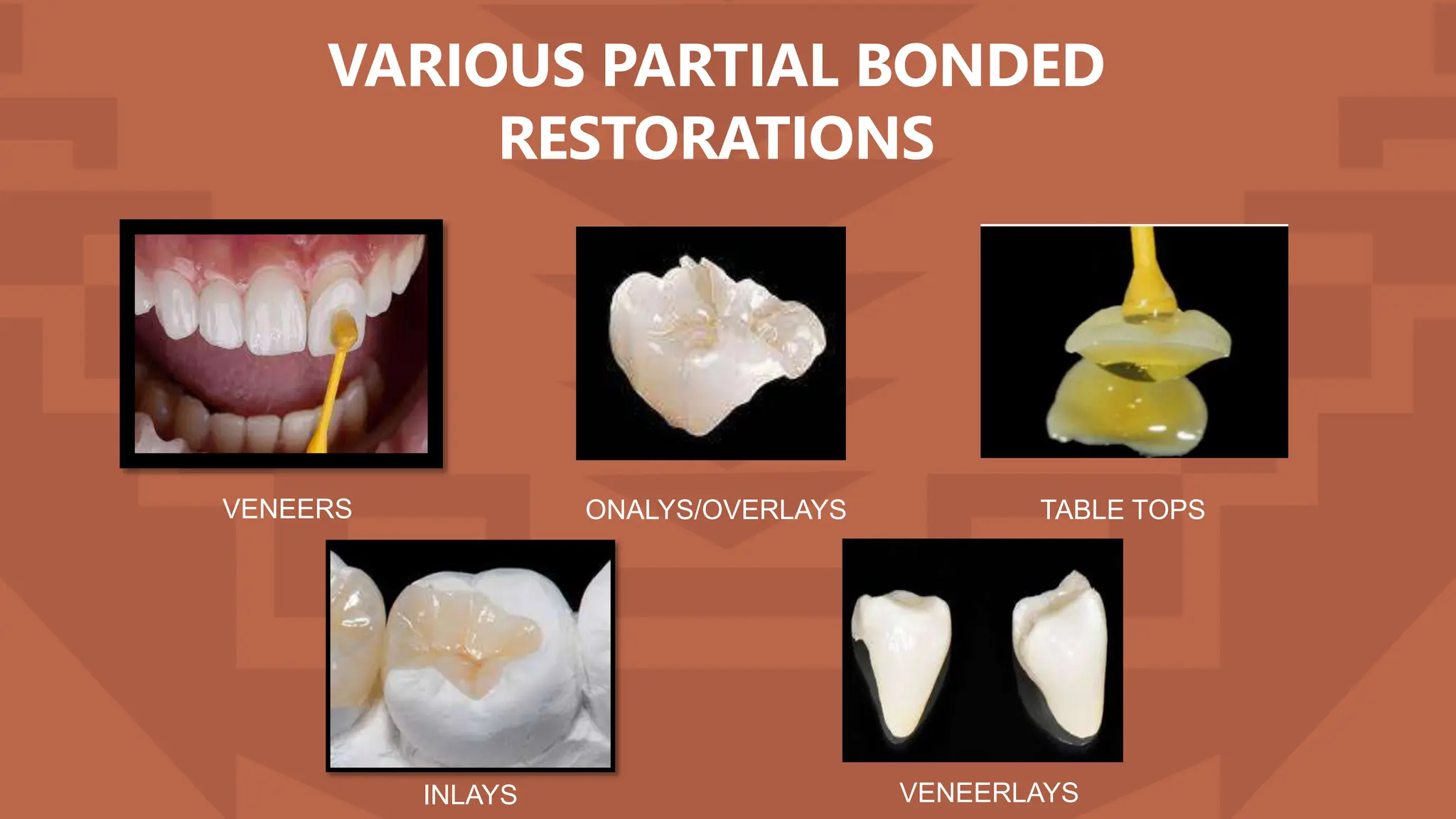 PARTIAL BONDED RESTORATIONS AND IT’S ADHESION.pptx