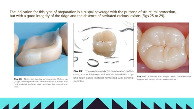 PARTIAL BONDED RESTORATIONS AND IT’S ADHESION.pptx