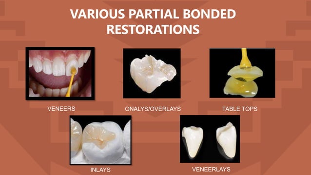PARTIAL BONDED RESTORATIONS AND IT’S ADHESION.pptx