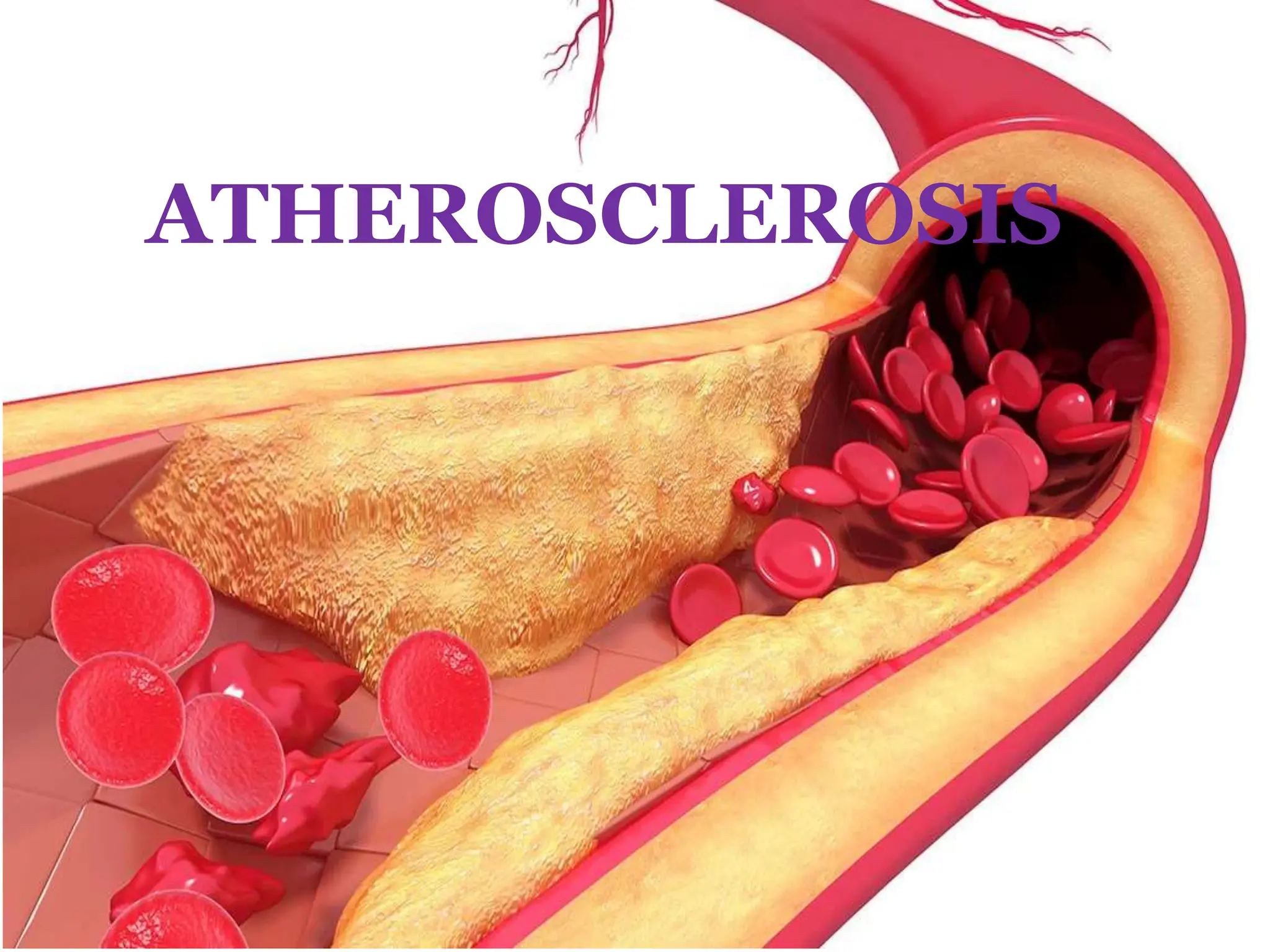 Atherosclerosis. pptx | PPTX