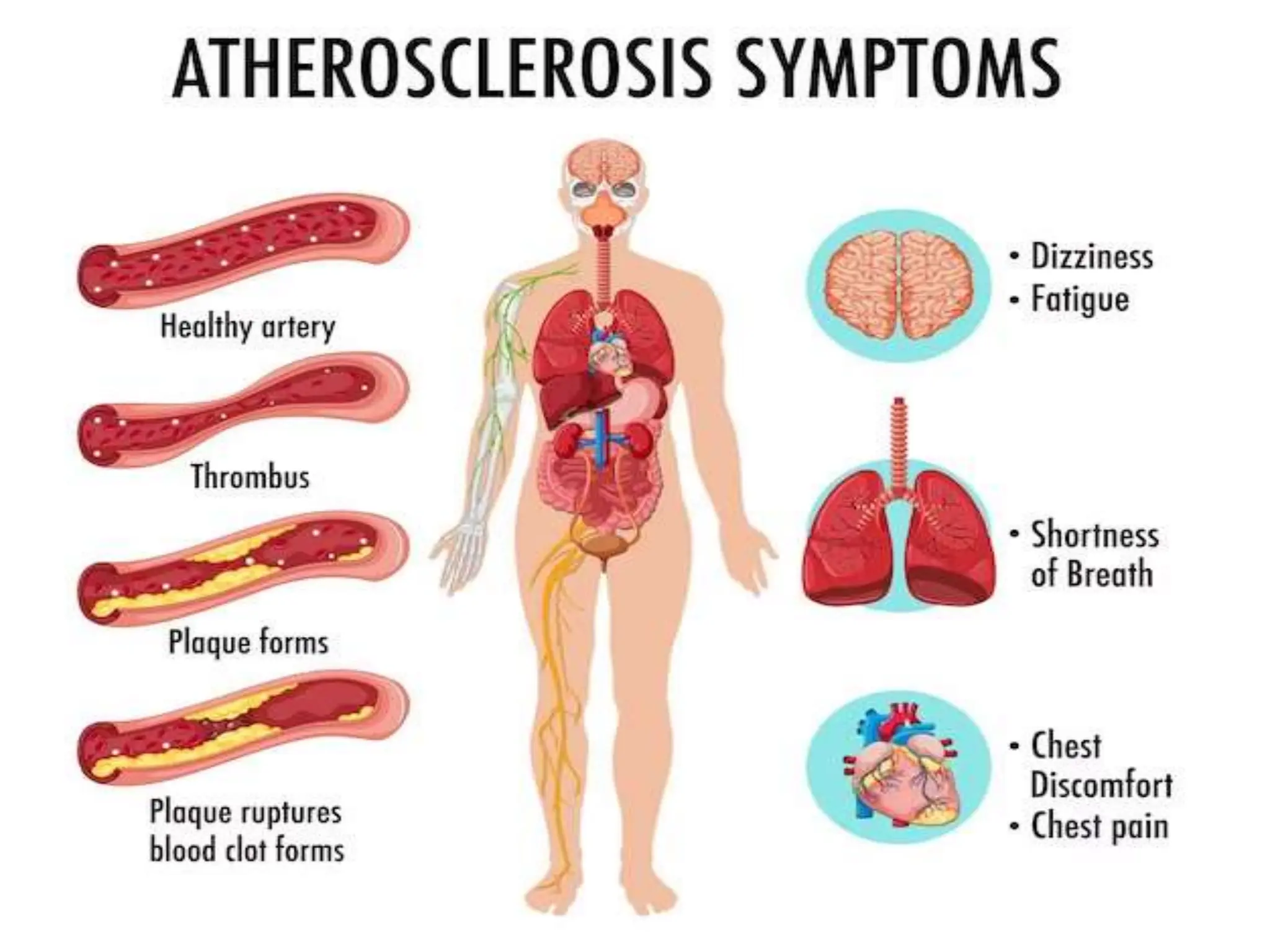 Atherosclerosis. pptx | PPTX