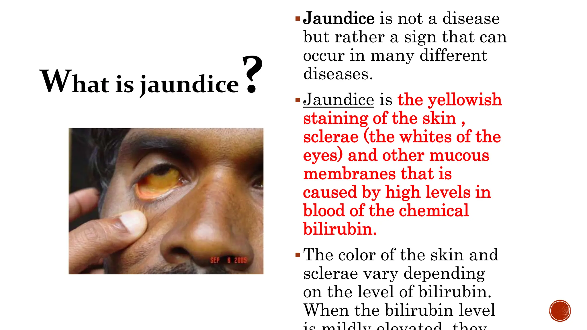 Obstructive jaundice in surgery By Doctor | PPTX