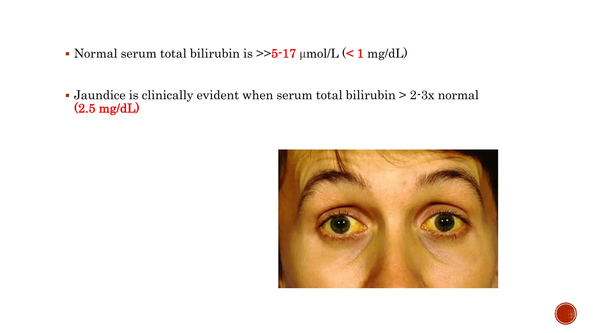 Obstructive jaundice in surgery By Doctor | PPTX