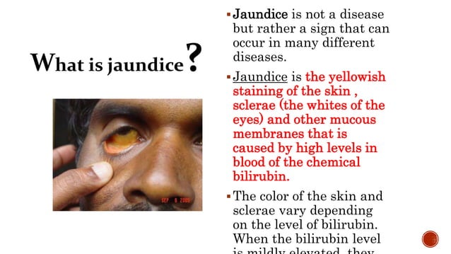 Obstructive jaundice in surgery By Doctor | PPTX | Digestive Disorders ...
