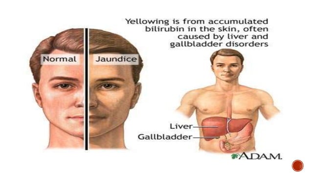Obstructive jaundice in surgery By Doctor | PPTX | Digestive Disorders ...