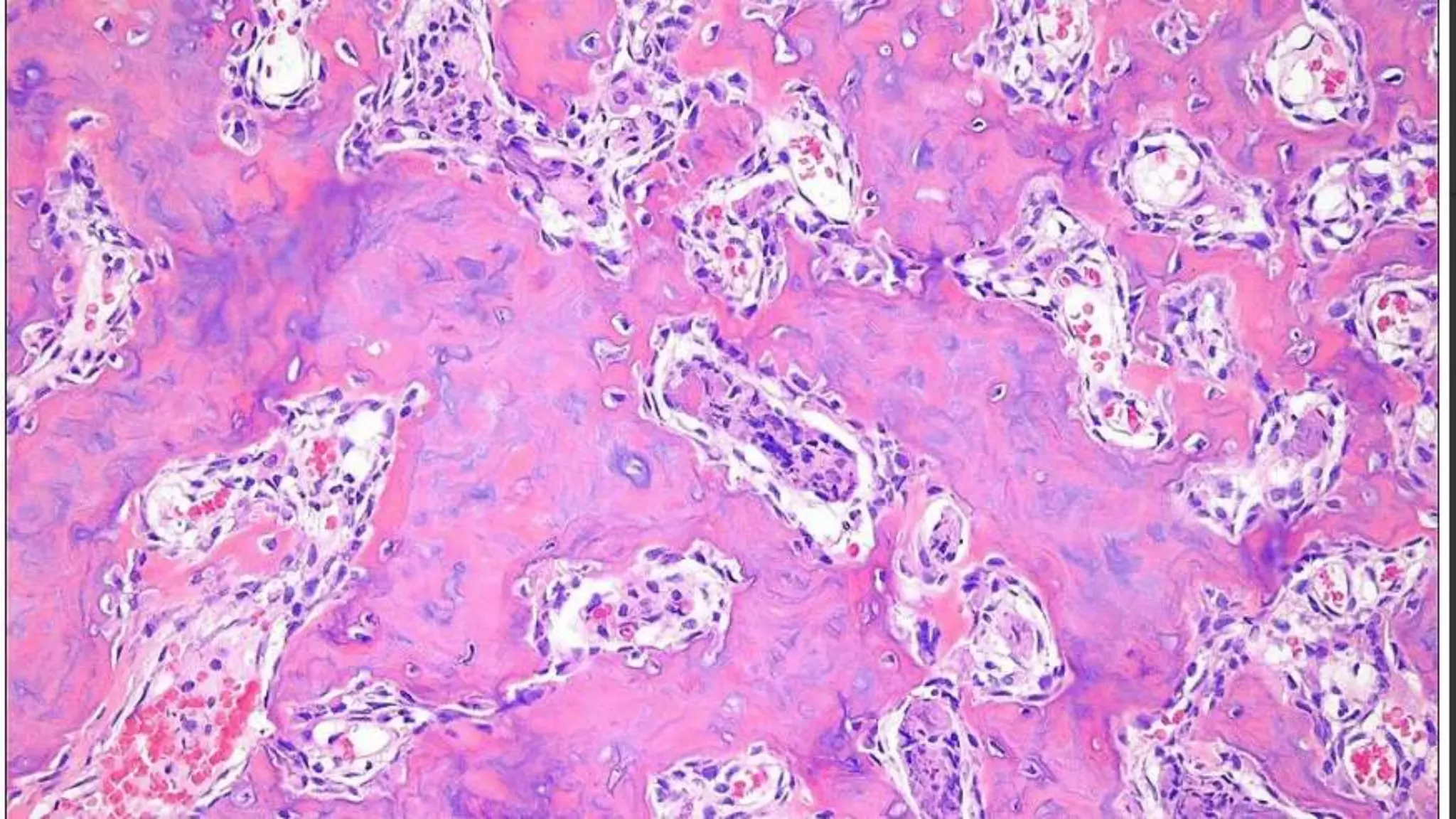 Osteoid Osteoma and Osteoid sarcoma.pptx