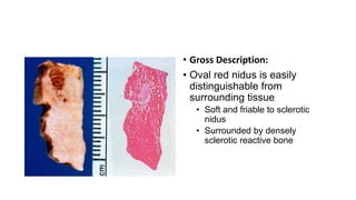Osteoid Osteoma and Osteoid sarcoma.pptx
