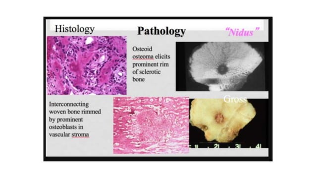 Osteoid Osteoma and Osteoid sarcoma.pptx