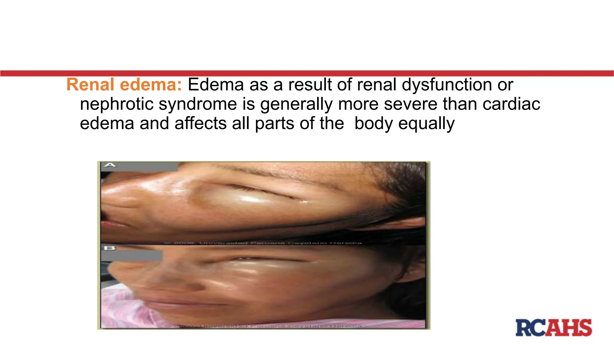 12. EDEMA introduction and causes treatment | PPT | Heart and ...