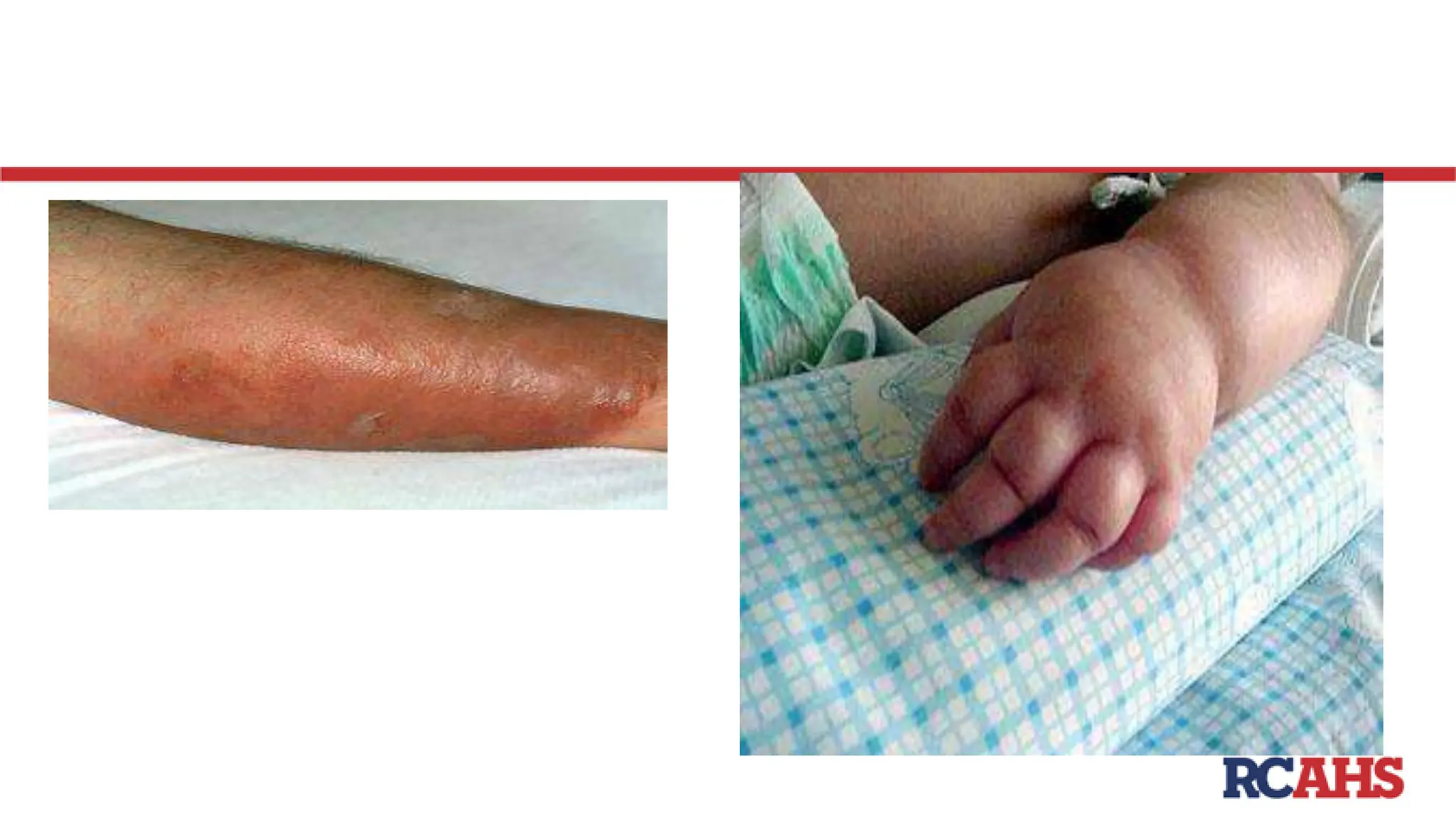 12. EDEMA introduction and causes treatment | PPT | Heart and ...