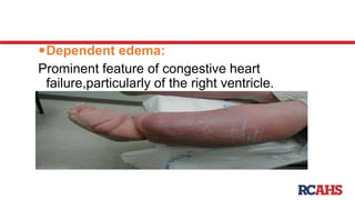 12. EDEMA introduction and causes treatment | PPT