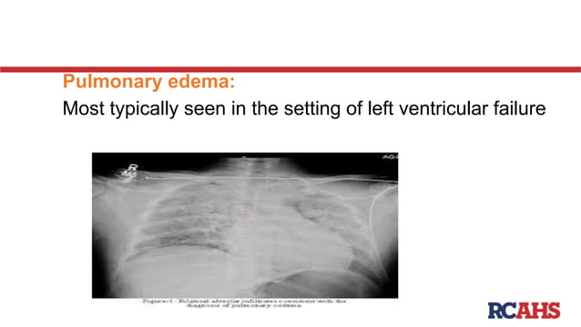 12. EDEMA introduction and causes treatment | PPT