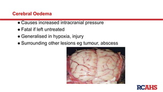 12. EDEMA introduction and causes treatment | PPT