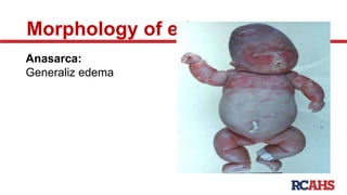 12. EDEMA introduction and causes treatment | PPT | Heart and ...