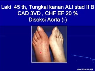 DIAGNOSE AND MANAGEMENT OF ACUTE LIMB ISCHEMIA.pptx