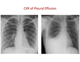 Pleural Effusion and its pathophysiology | PDF