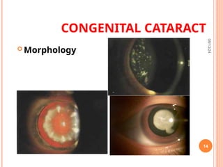 12.chapter 3. Lecfure one CATARACT inppt | PPT