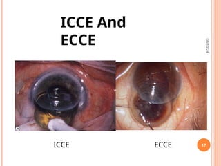 12.chapter 3. Lecfure one CATARACT inppt | PPT