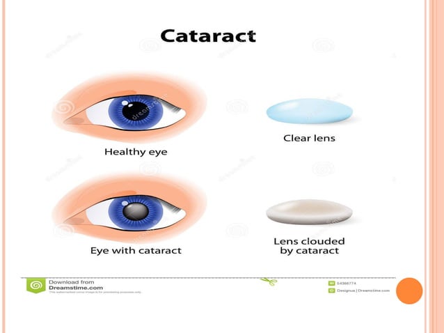 12.chapter 3. Lecfure one CATARACT inppt | PPT