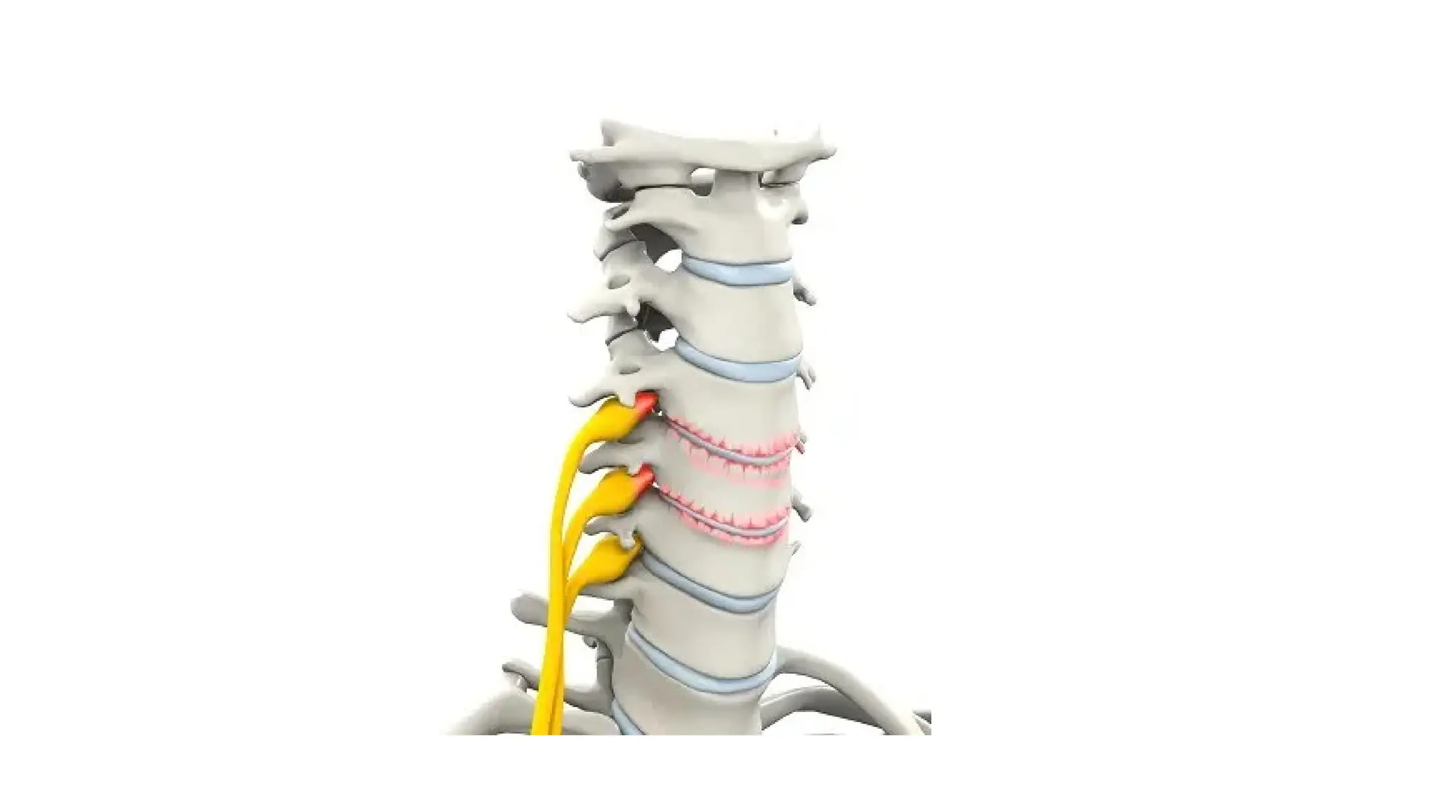 Cervical Spondylosis (Nutshell) with pictures | PPTX