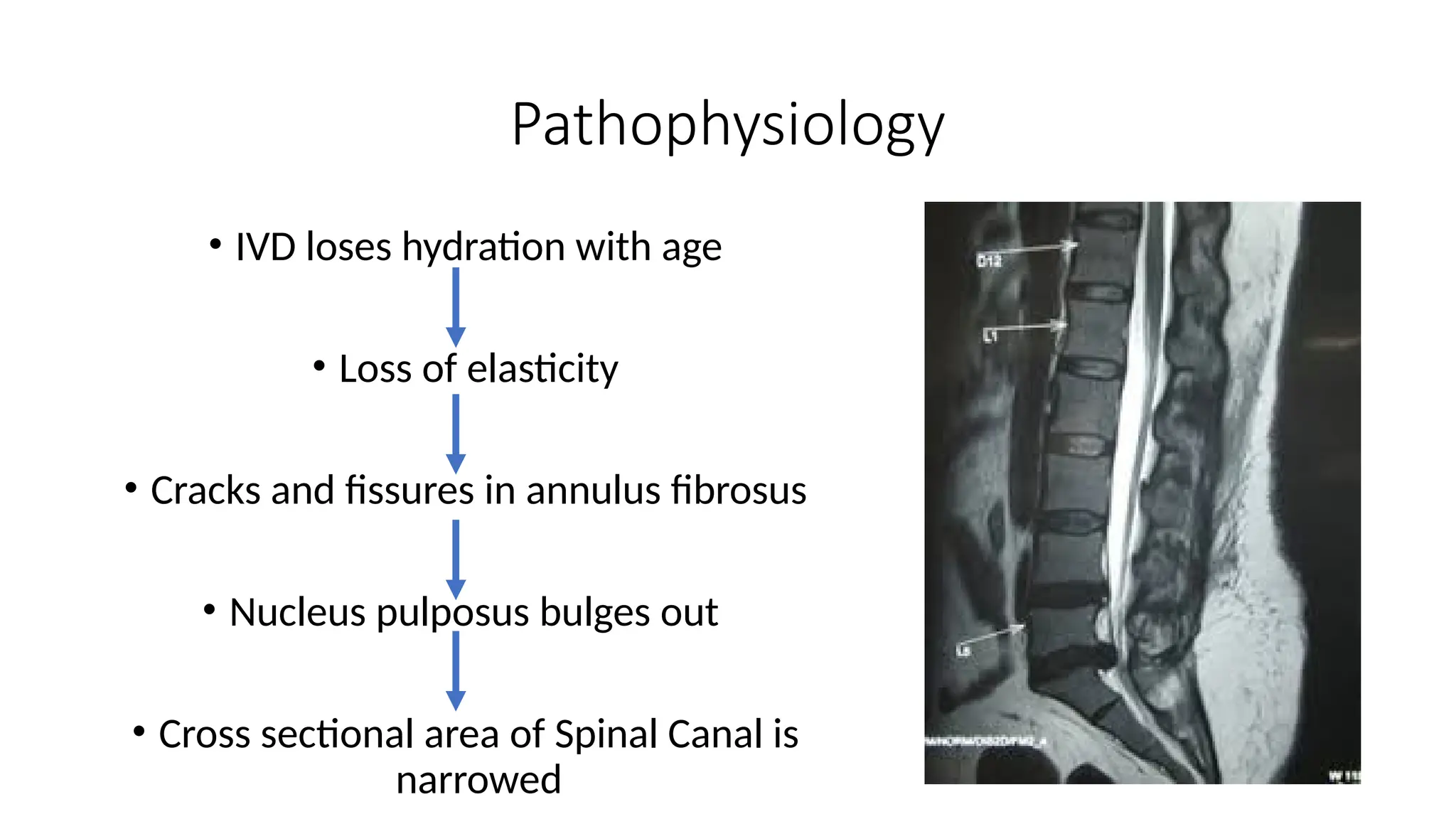 Cervical Spondylosis (Nutshell) with pictures | PPTX