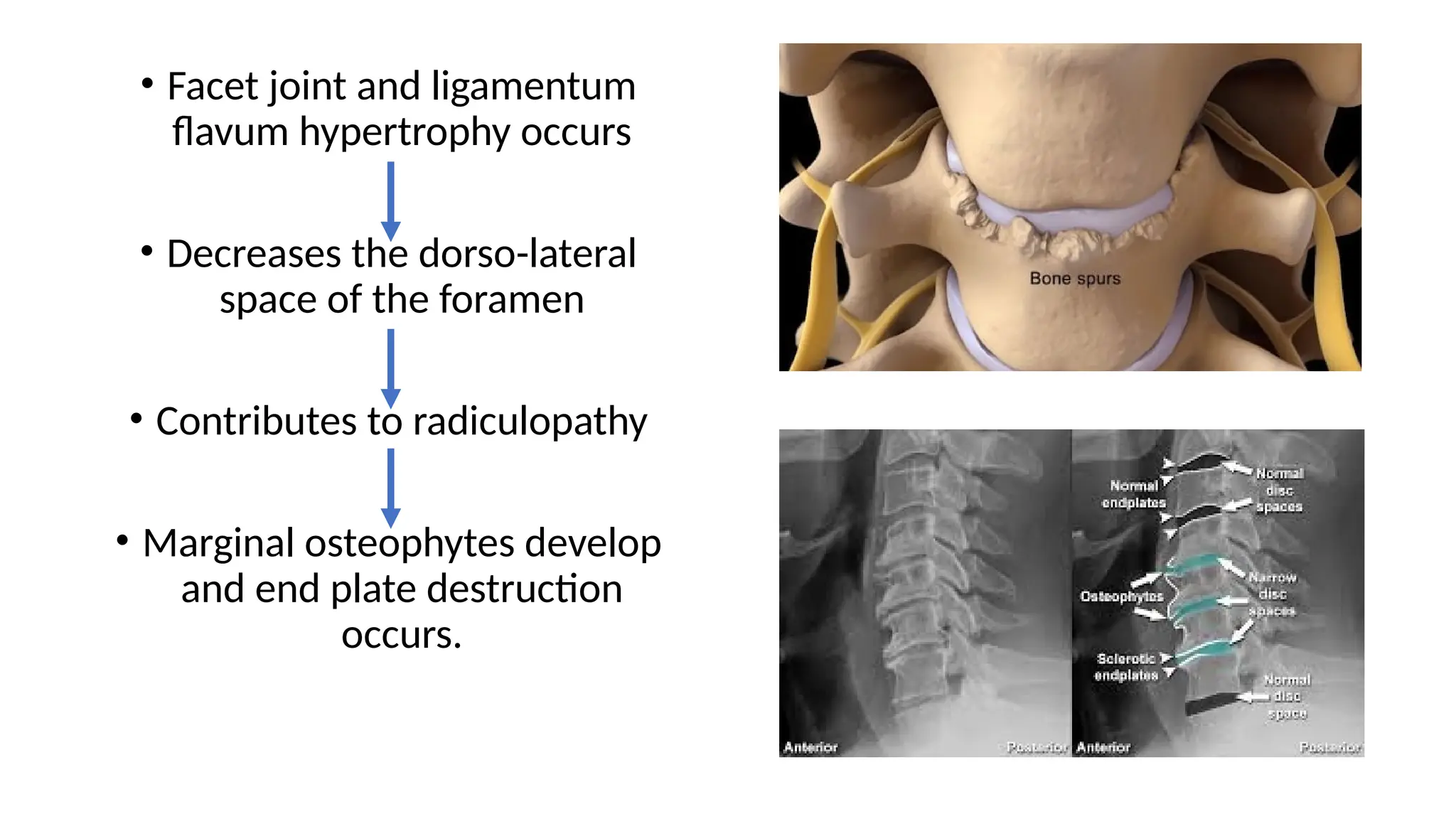 Cervical Spondylosis (Nutshell) with pictures | PPTX