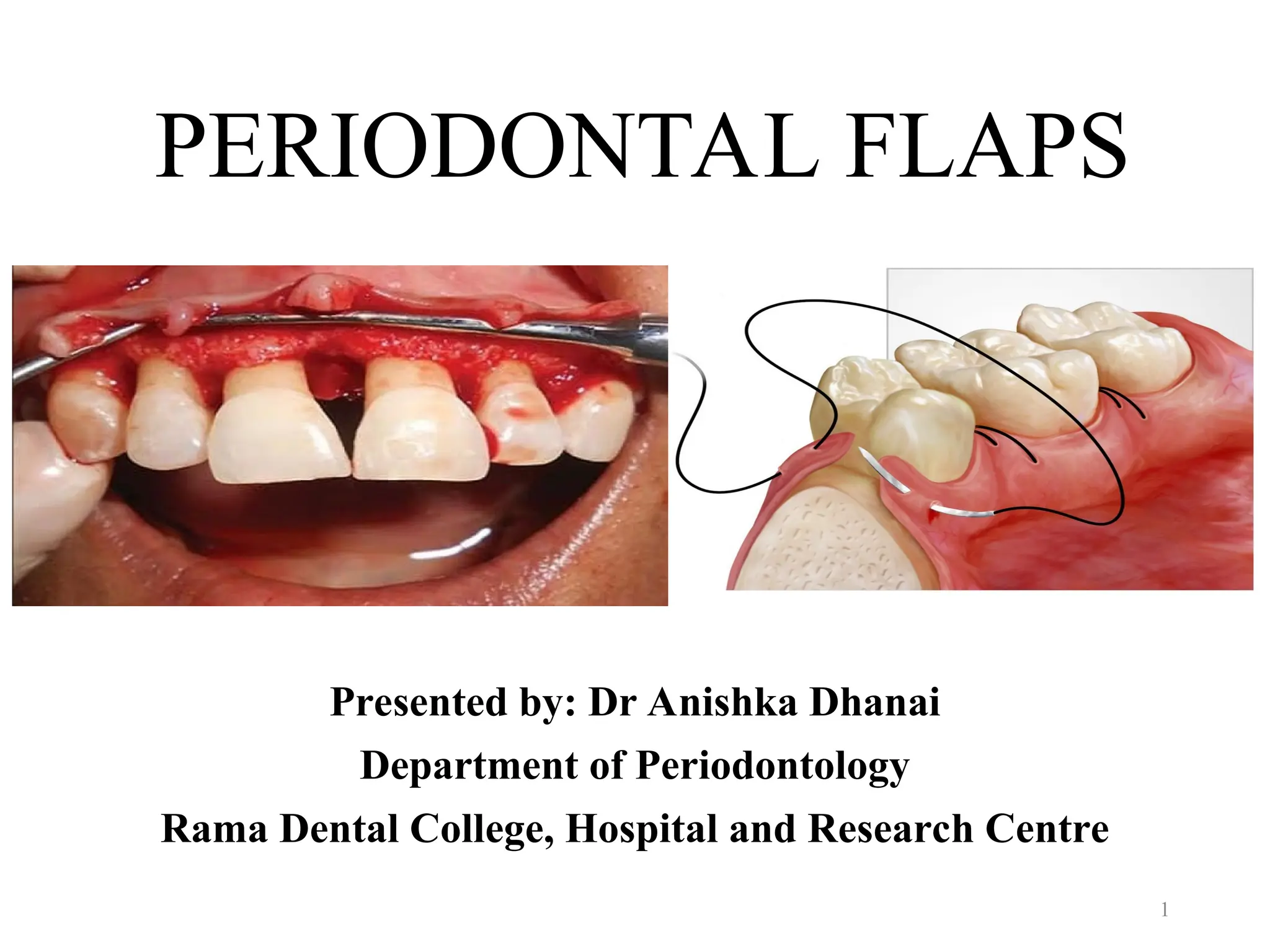 PERIODONTAL FLAP - Classification, Design, Healing | PPT