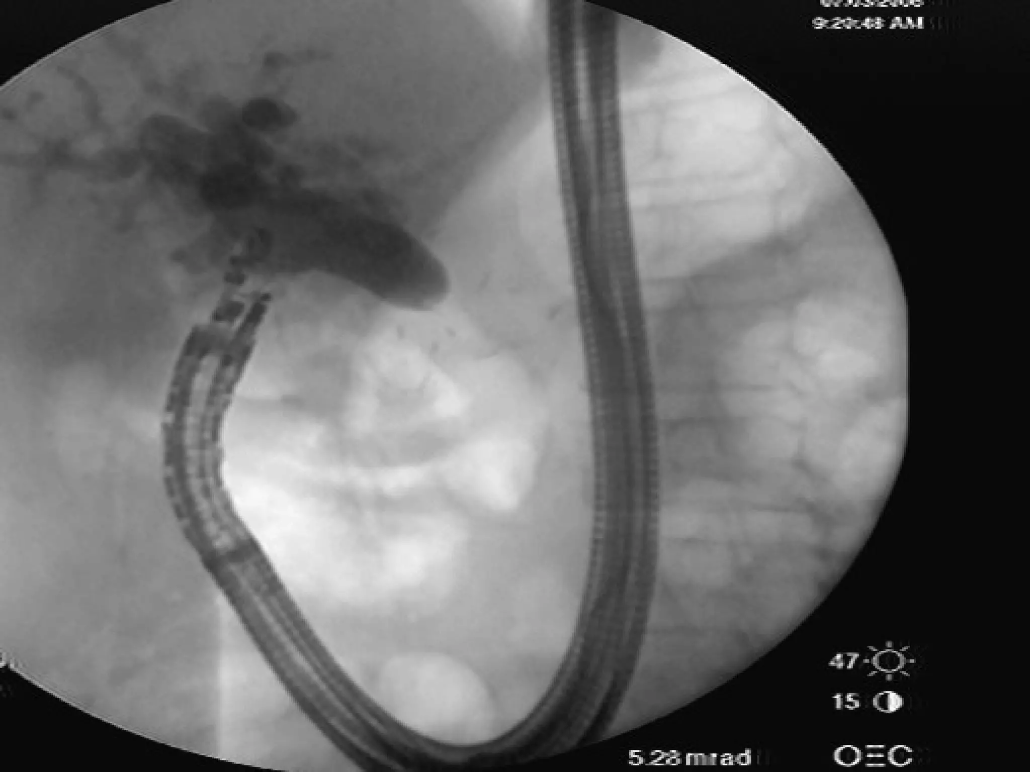 Endoscopy in Gastrointestinal Oncology - Slide 12 - J. Baillie ...
