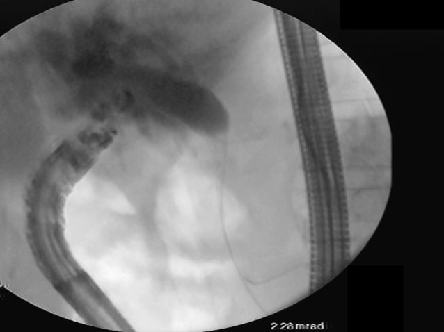 Endoscopy in Gastrointestinal Oncology - Slide 12 - J. Baillie ...
