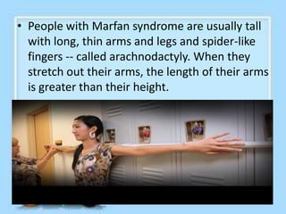 12. cobey marfan syndrome | PPTX